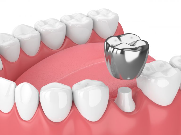 Versatility With Restorative Crowns | Overland Park, KS